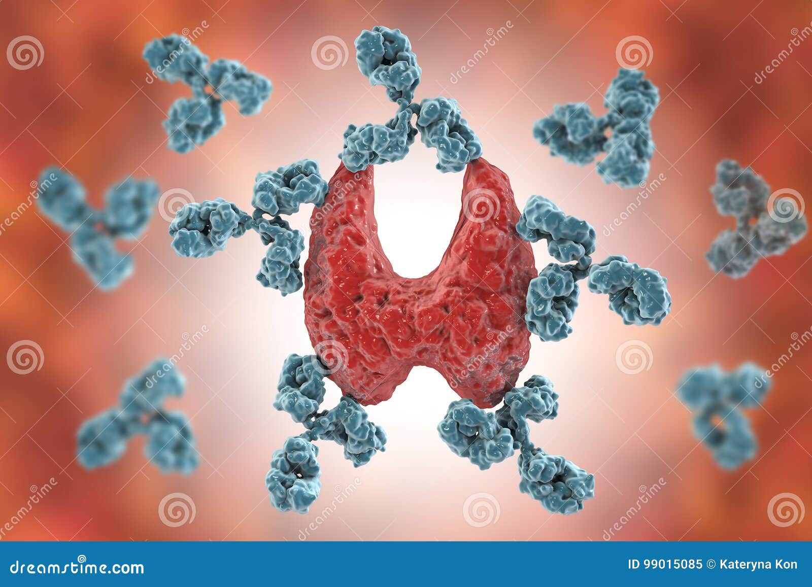 Tiroidite Autoimmune, Malattia Del ` S Di Hashimoto Illustrazione di ...