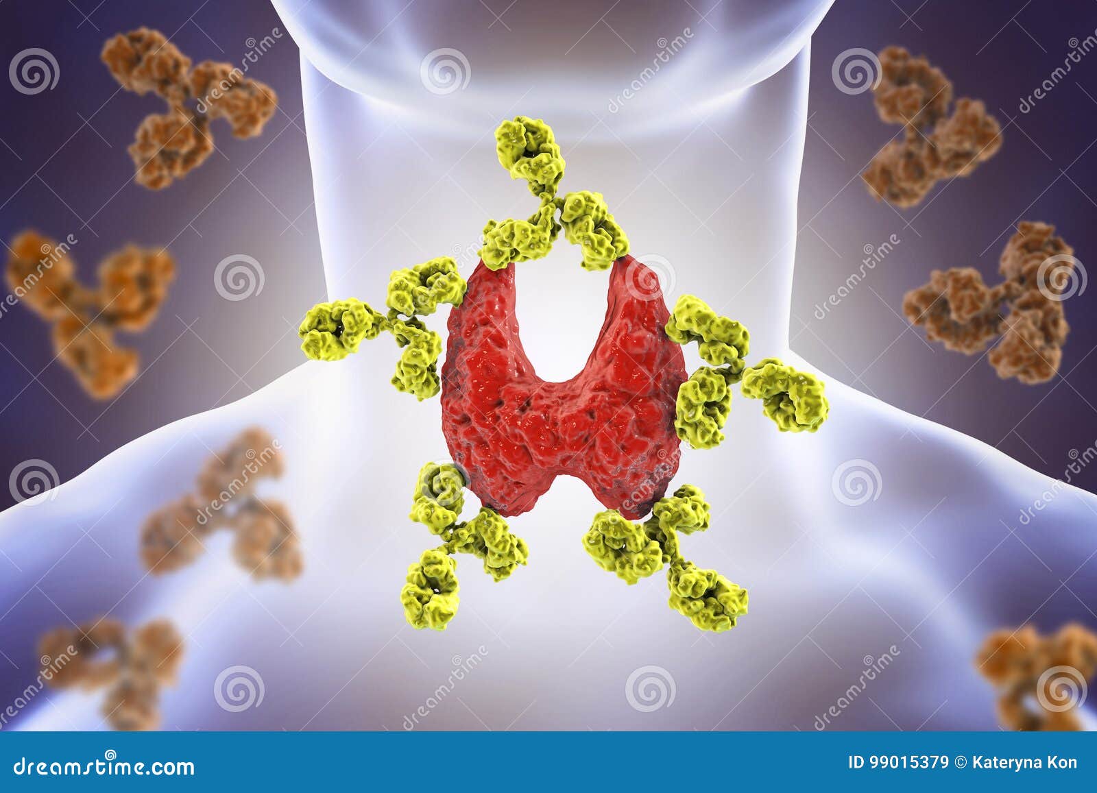 Tiroidite Autoimmune, Malattia Del ` S Di Hashimoto Illustrazione di ...