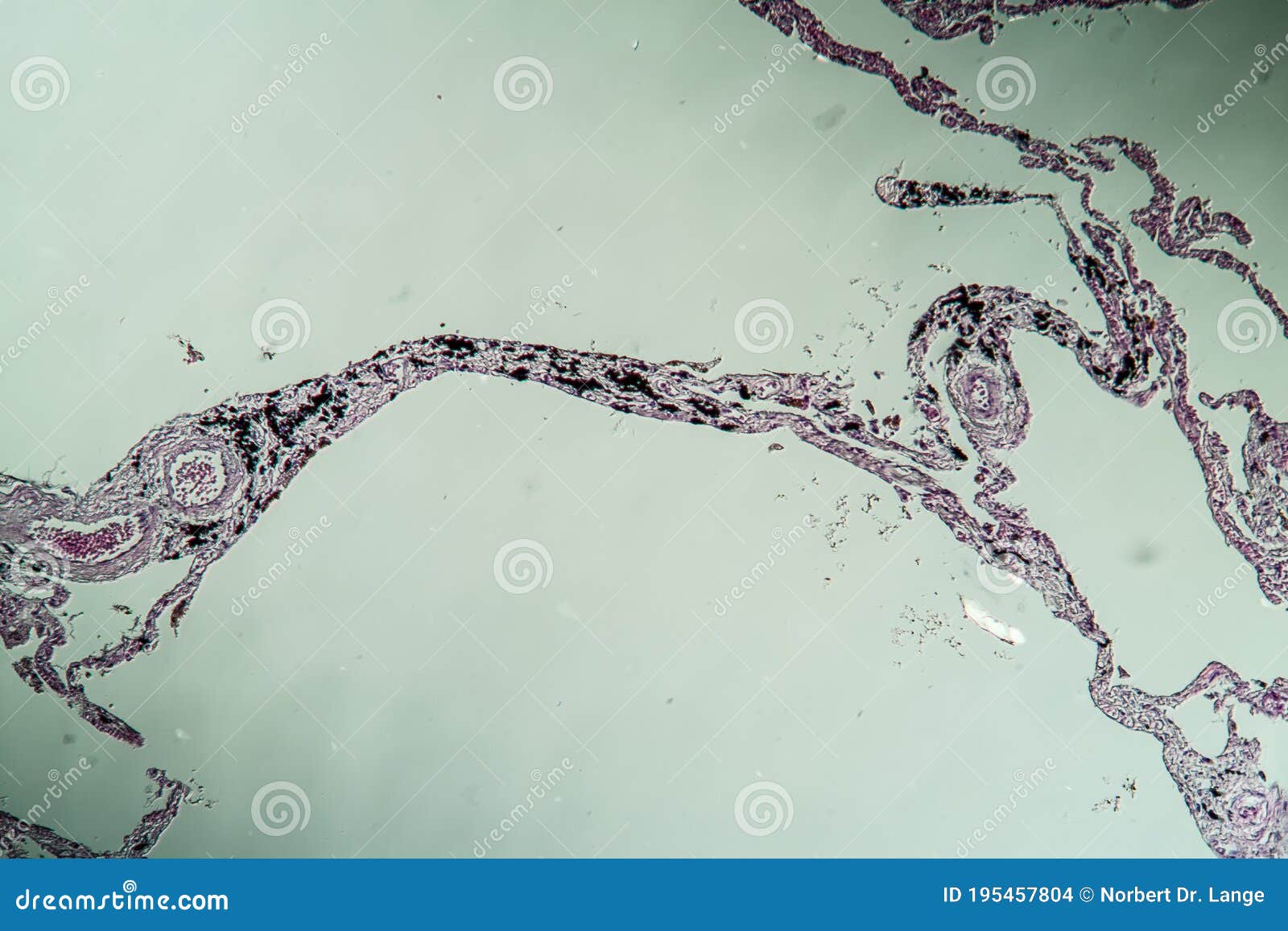 Tissue Contaminated with Asbestosis Stock Photo - Image of magnifying ...