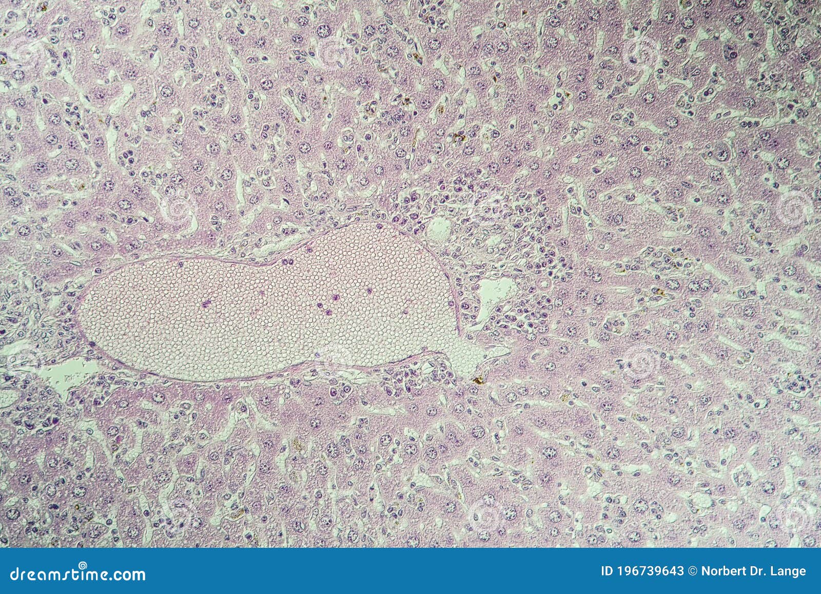 Tissue with Schistosomiasis Sick Tissue Stock Image - Image of tiny ...