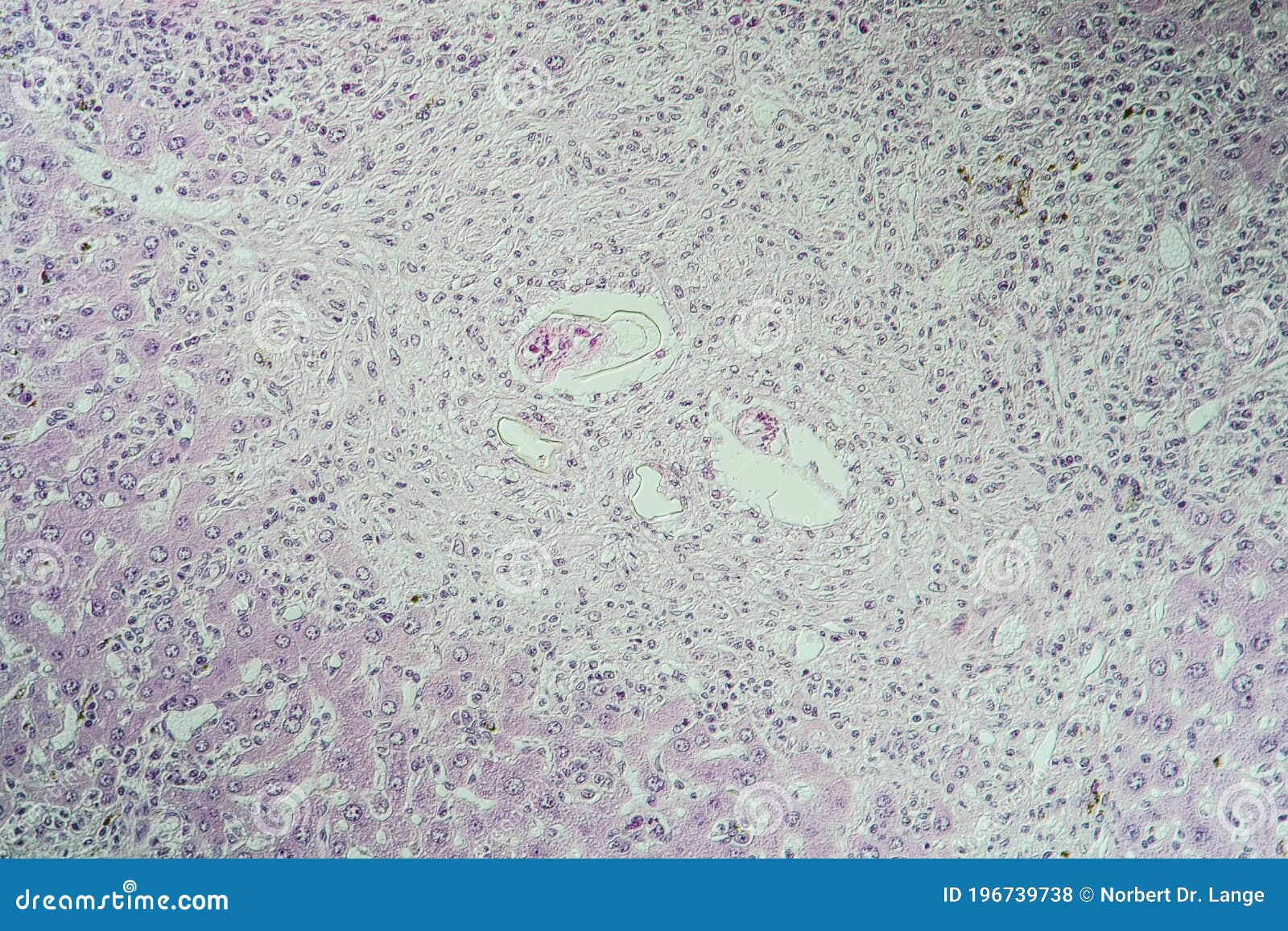 Tissue with Schistosomiasis Sick Tissue Stock Photo - Image of ...