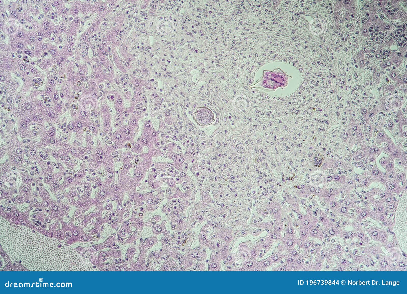 Tissue with Schistosomiasis Sick Tissue Stock Photo - Image of ...