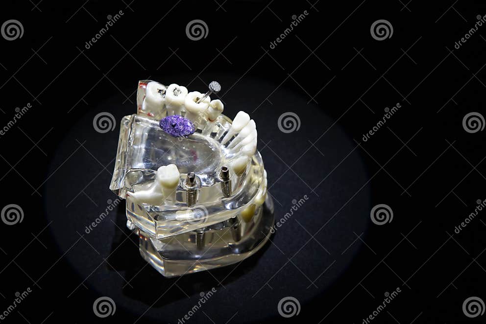 Titanium Implants. a Plastic Model of the Jaw with Teeth for Studying ...