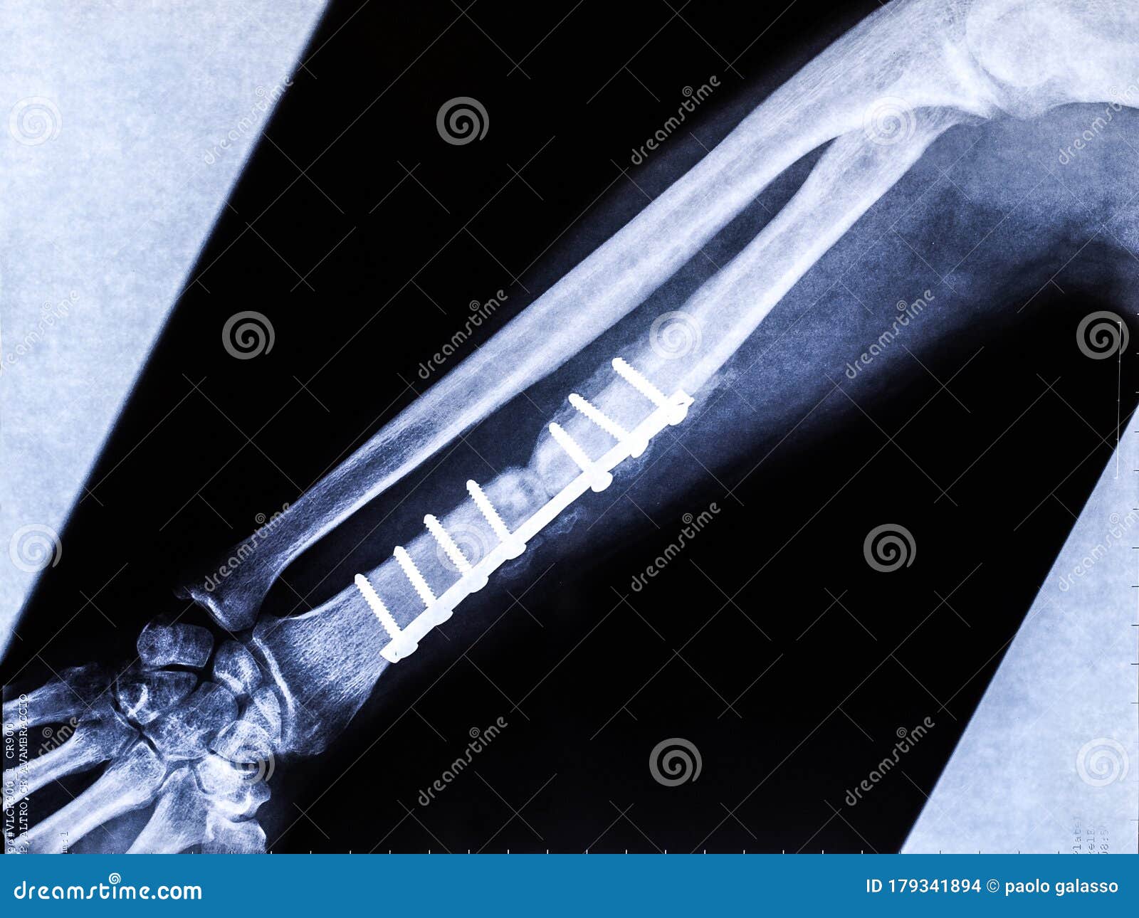 Titanium Plate on Radius Bone in a Diagnostic Radiograph Post Surgical ...
