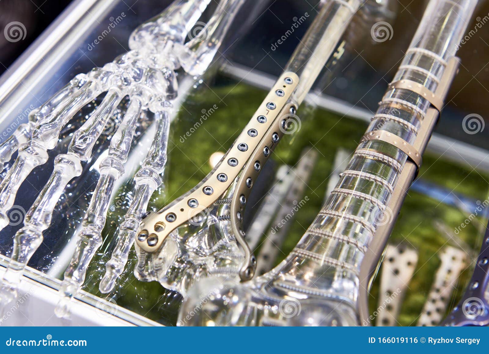 Titanium Plates for Splicing Bones Stock Photo - Image of fixed ...