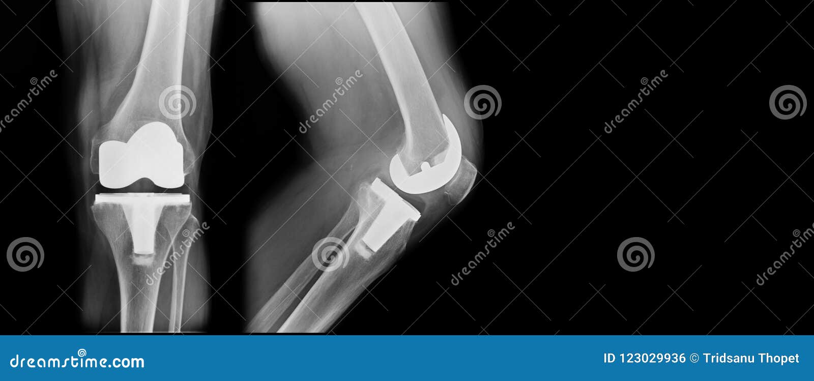 TKA knee joint x-ray stock photo. Image of health, accident - 123029936