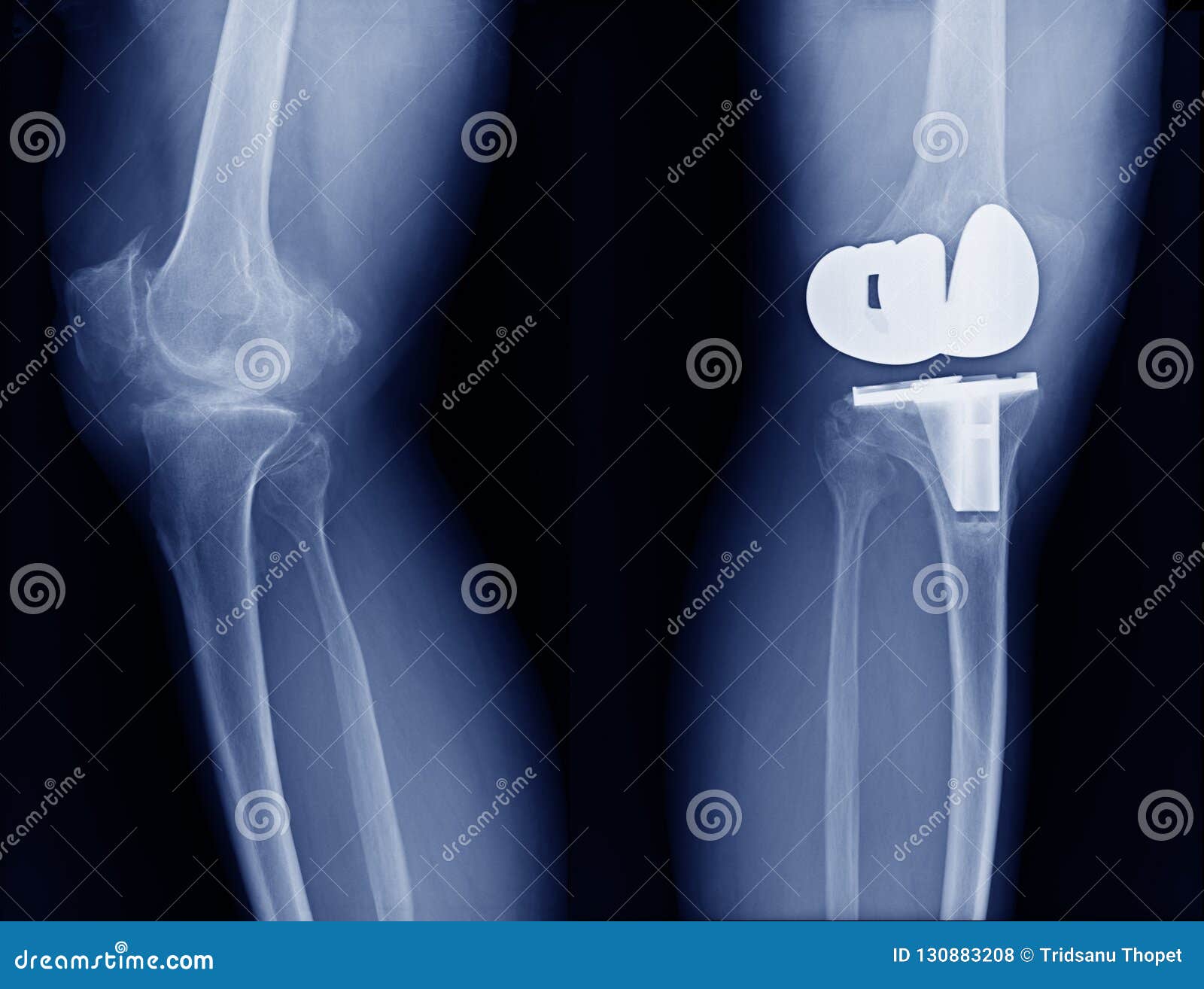 Hight Quality X-ray with Knee Joint Replacement Stock Photo - Image of ...