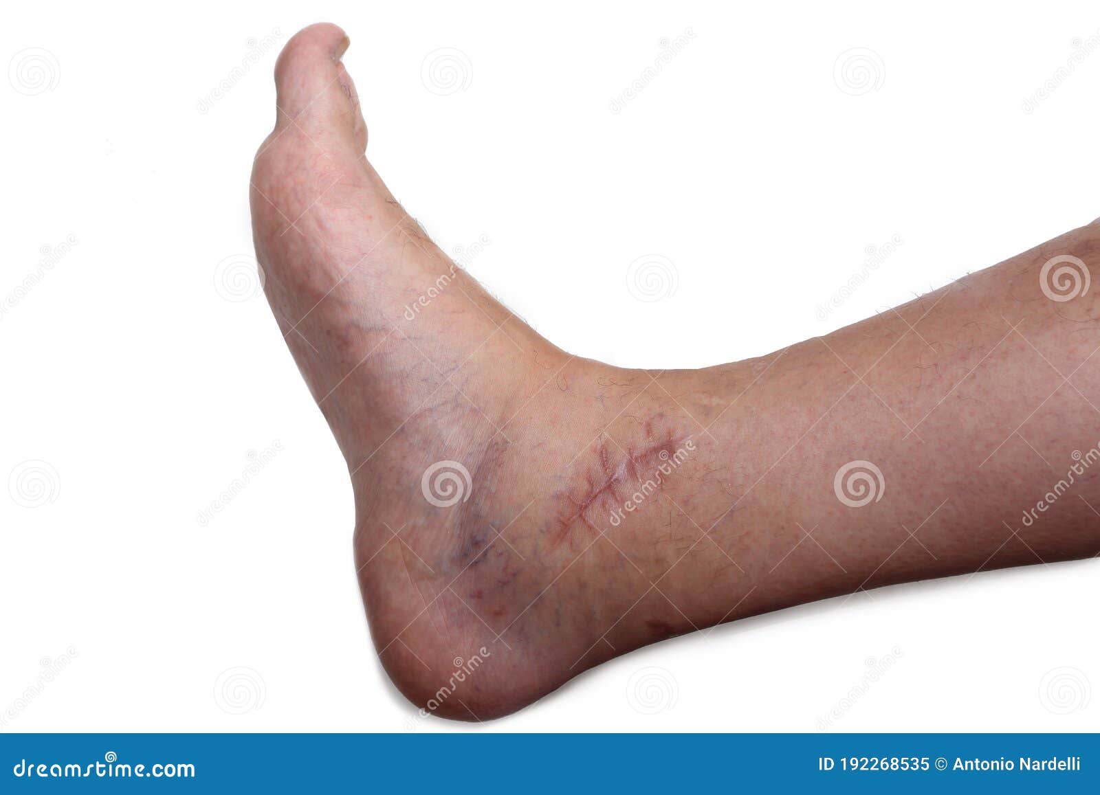 Tobillo postoperatorio imagen de archivo. Imagen de pierna - 192268535