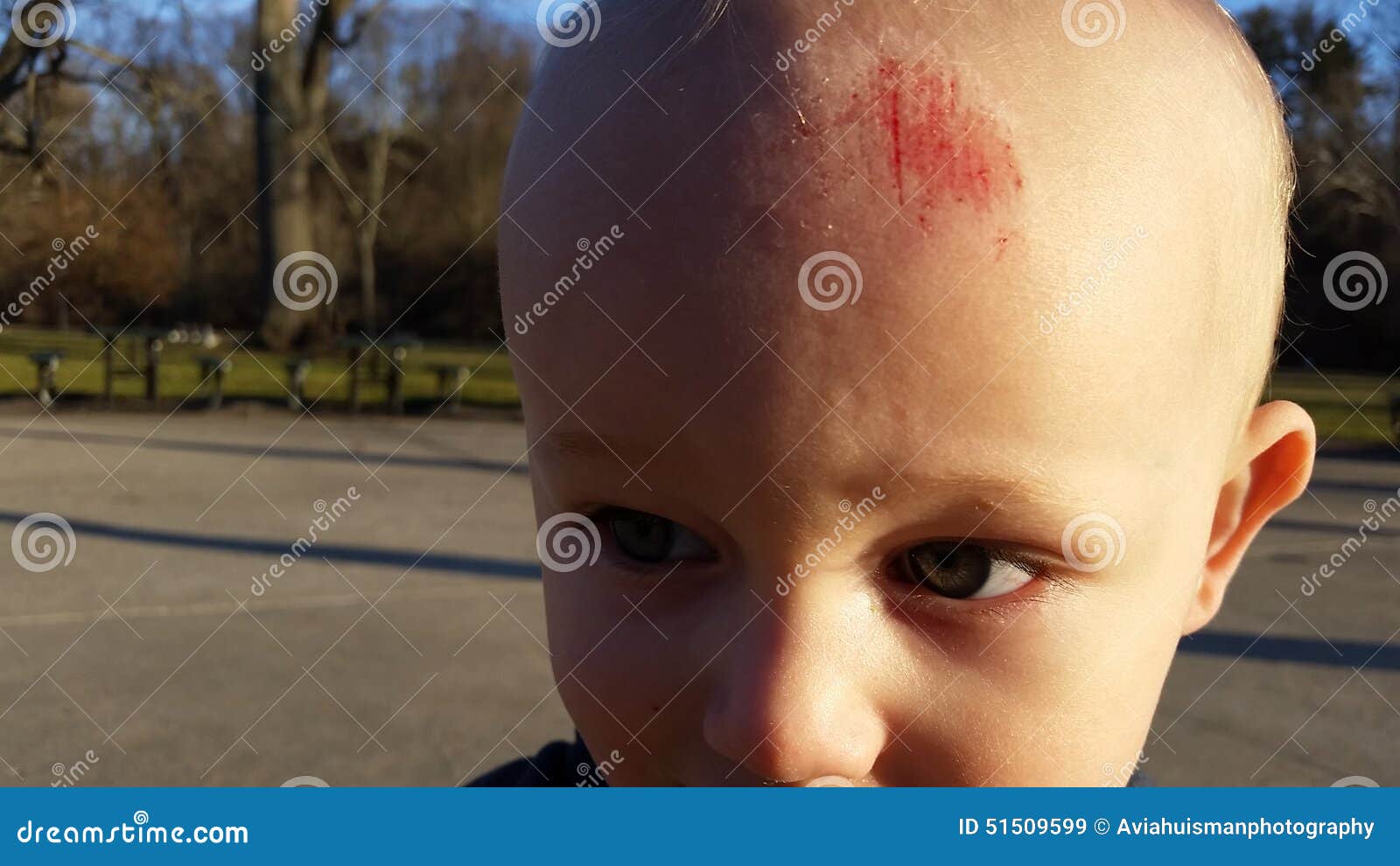 Toddler with Head Injury stock image. Image of clean - 51509599