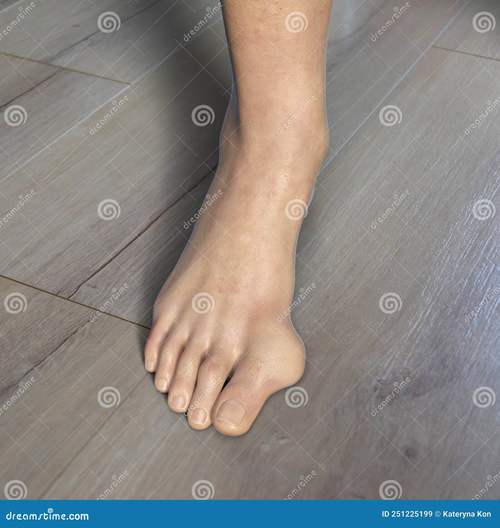 Toe Deformation, Also Known As Hallux Valgus, or Bunion, Illustration ...