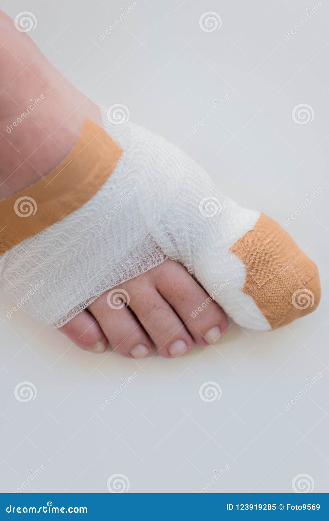 Toe Operation on the Big Toe in the Hospital Stock Image - Image of ...