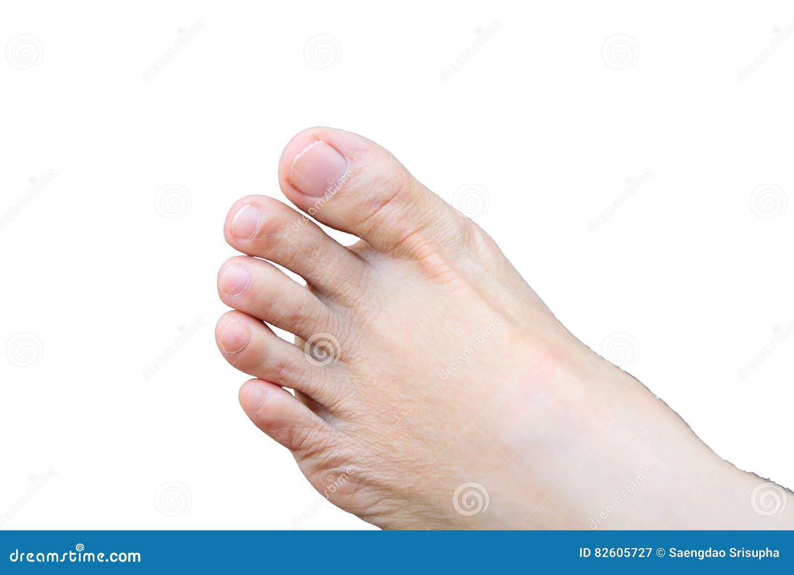 Toe stock image. Image of feet, fungus, clinical, closeup - 82605727
