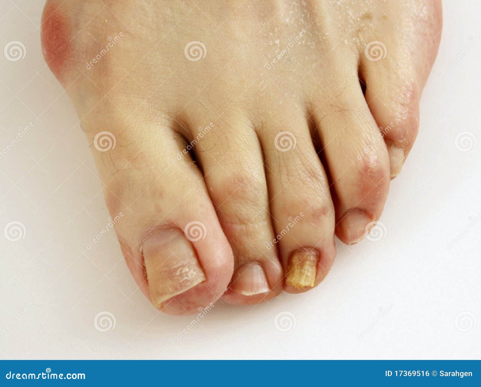 Toenail Fungus stock photo. Image of toenail, toes, yellowing - 17369516