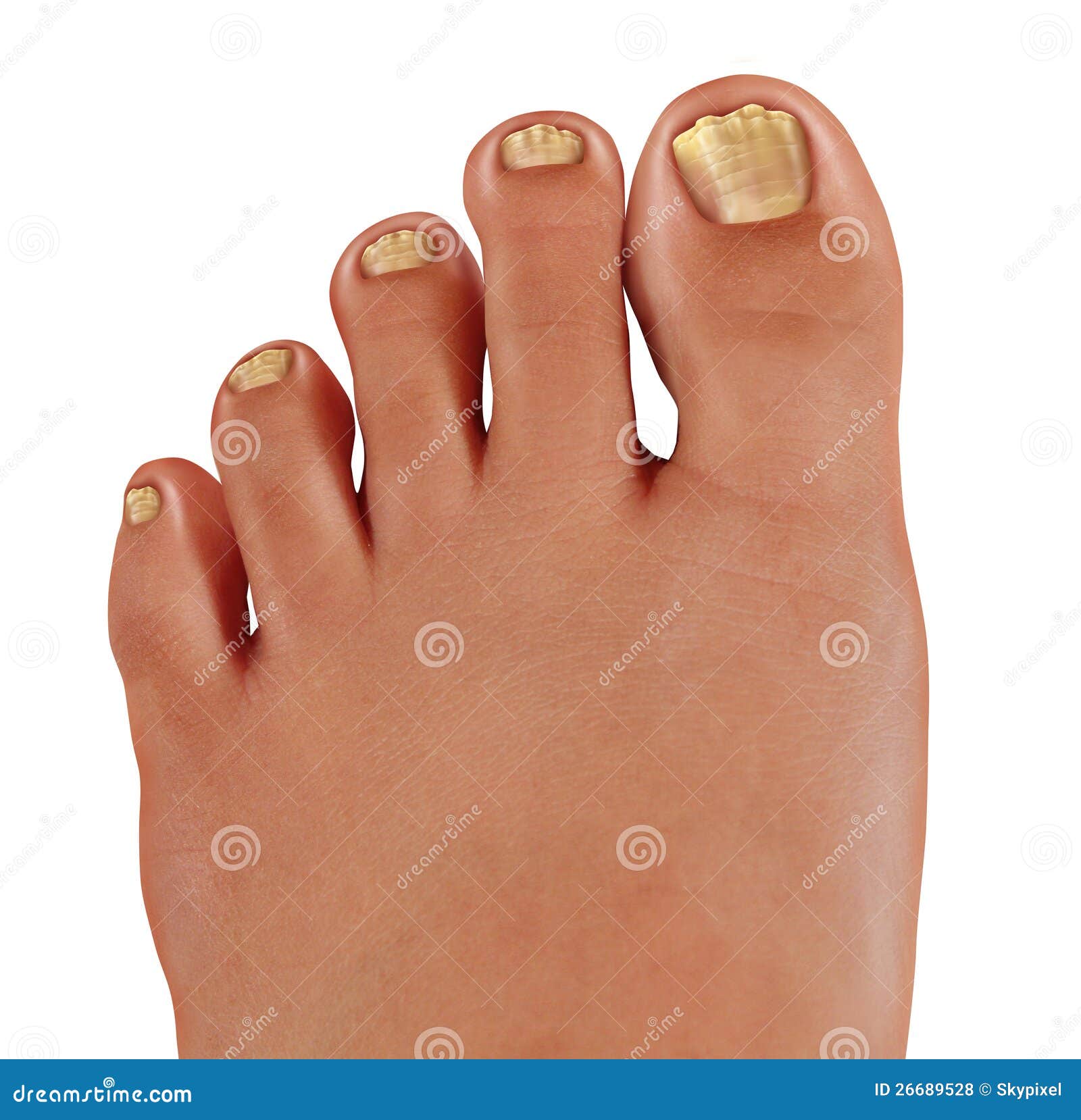 Toenail Stock Illustrations – 1,189 Toenail Stock Illustrations ...