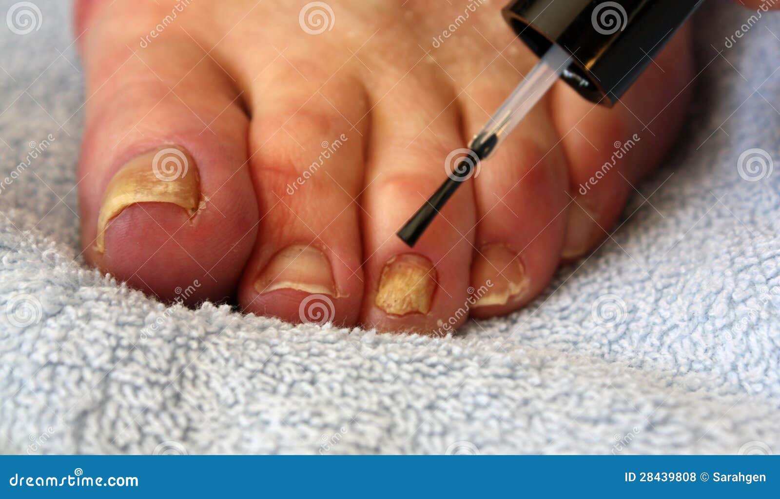 Fungal Toenail Polish