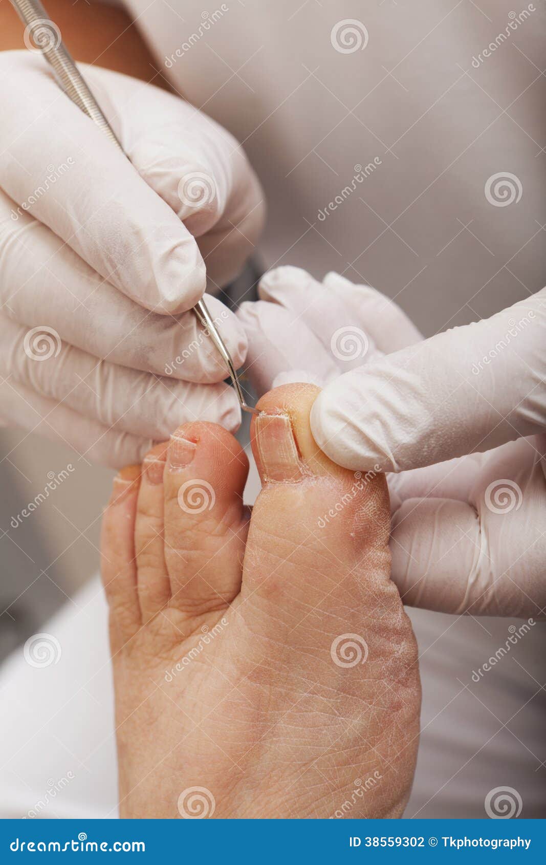 Toenail Lifter stock photo. Image of podiatric, pedicure - 38559302