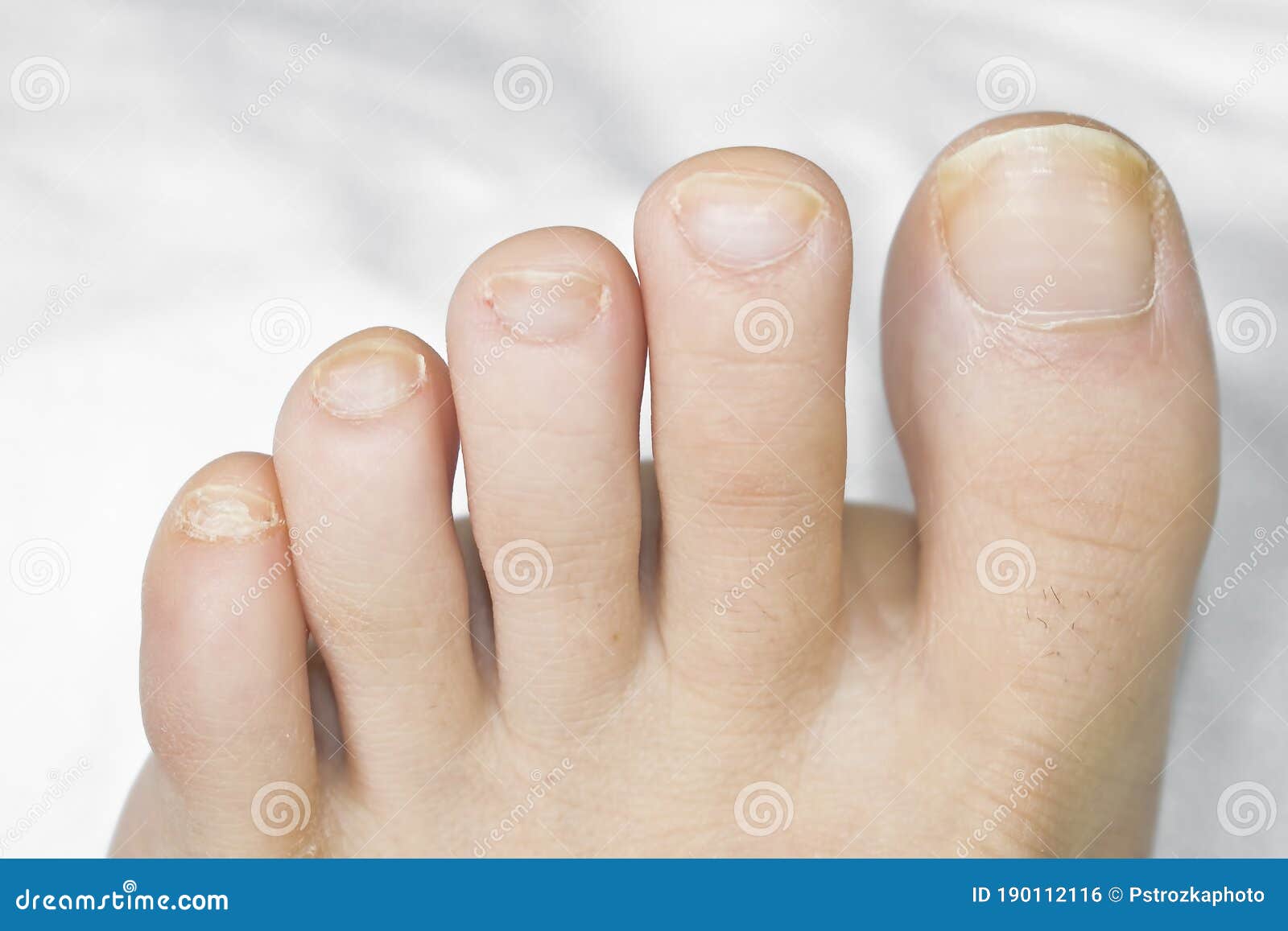 Toenails on a woman`s feet stock photo. Image of health - 190112116