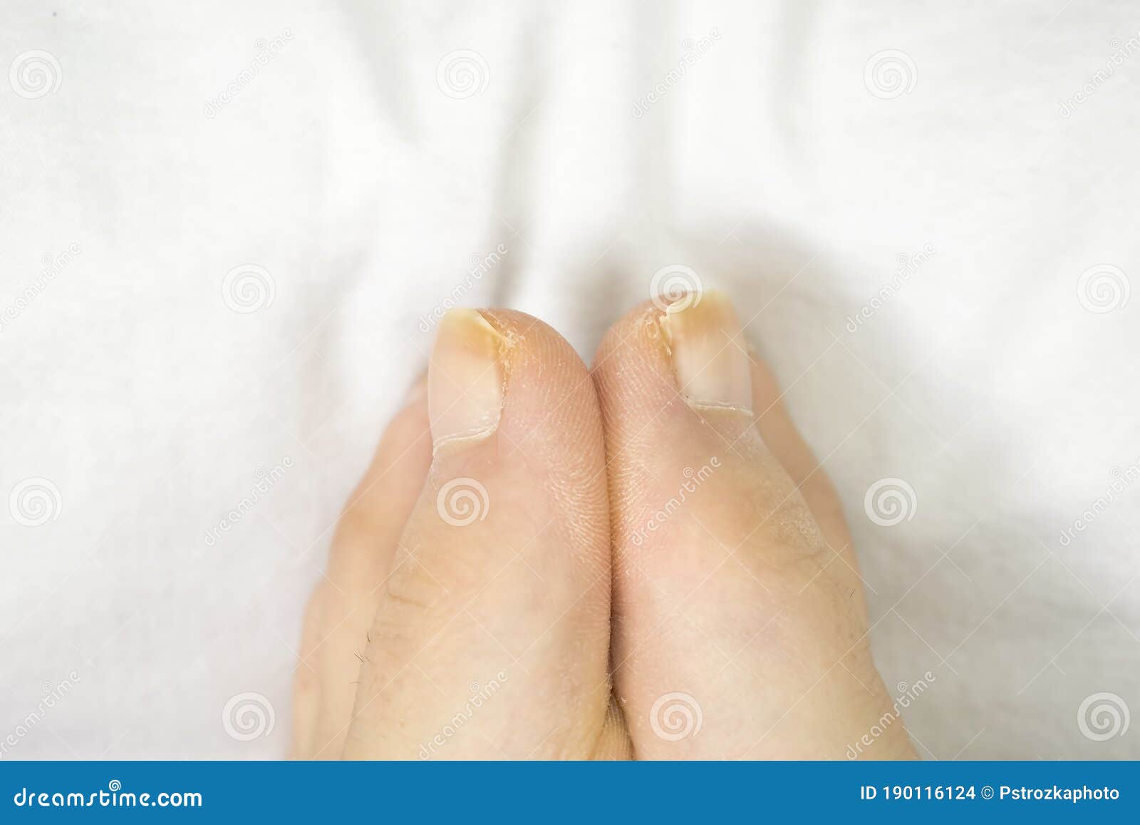 Toenails on a woman`s feet stock photo. Image of fungal - 190116124
