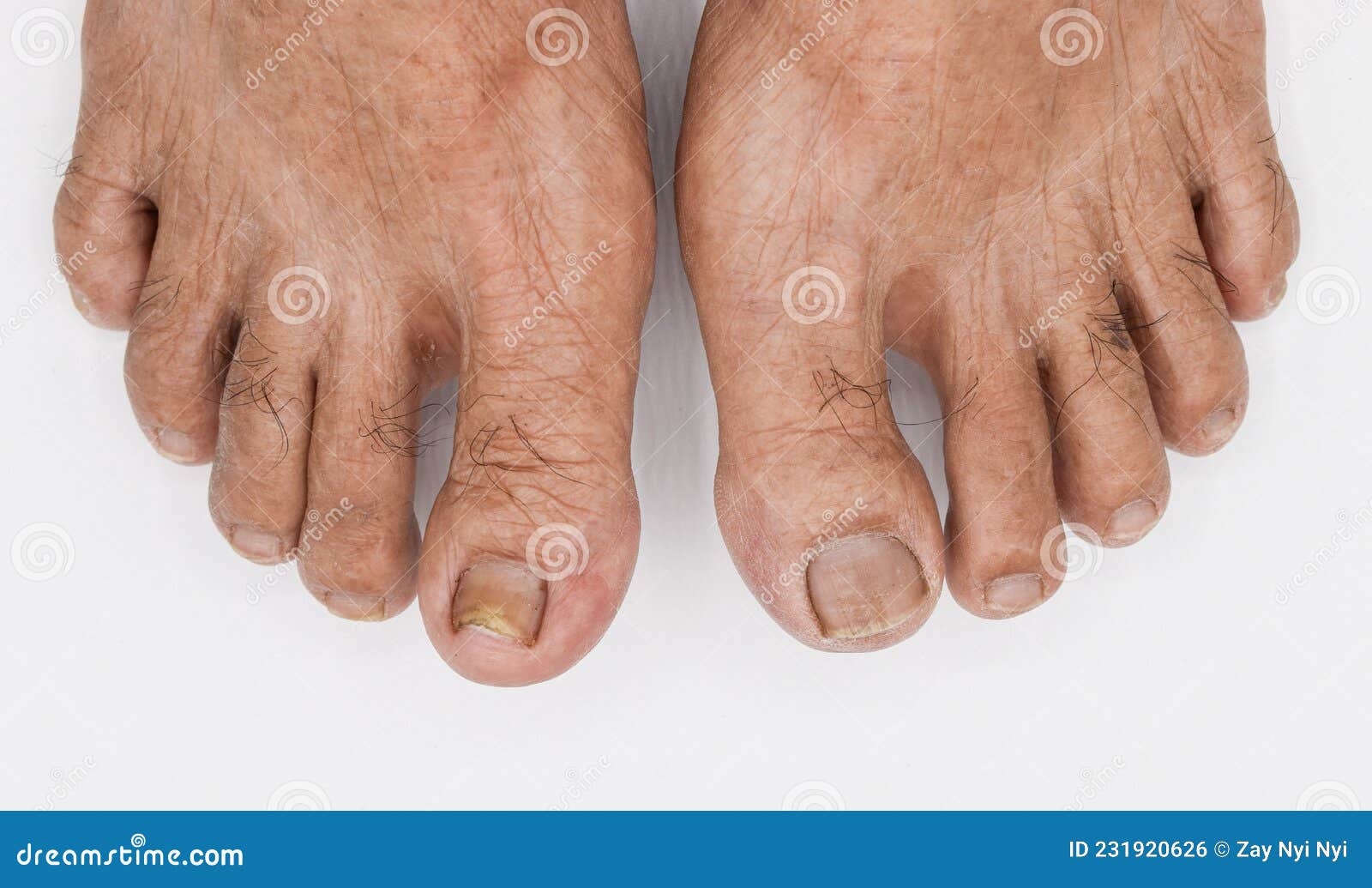 Toes of Asian Elder Man. Concept of Aging Stock Photo - Image of fungus ...
