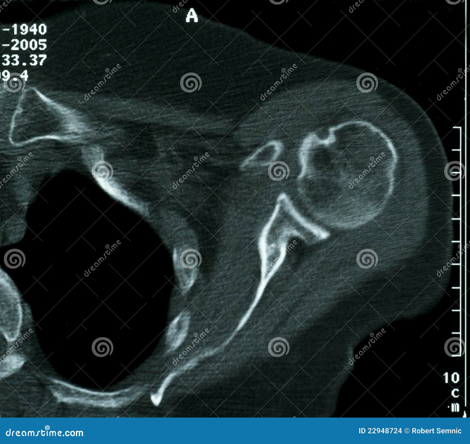 Tomografía Computada Del Hombro Foto de archivo - Imagen de fauna ...