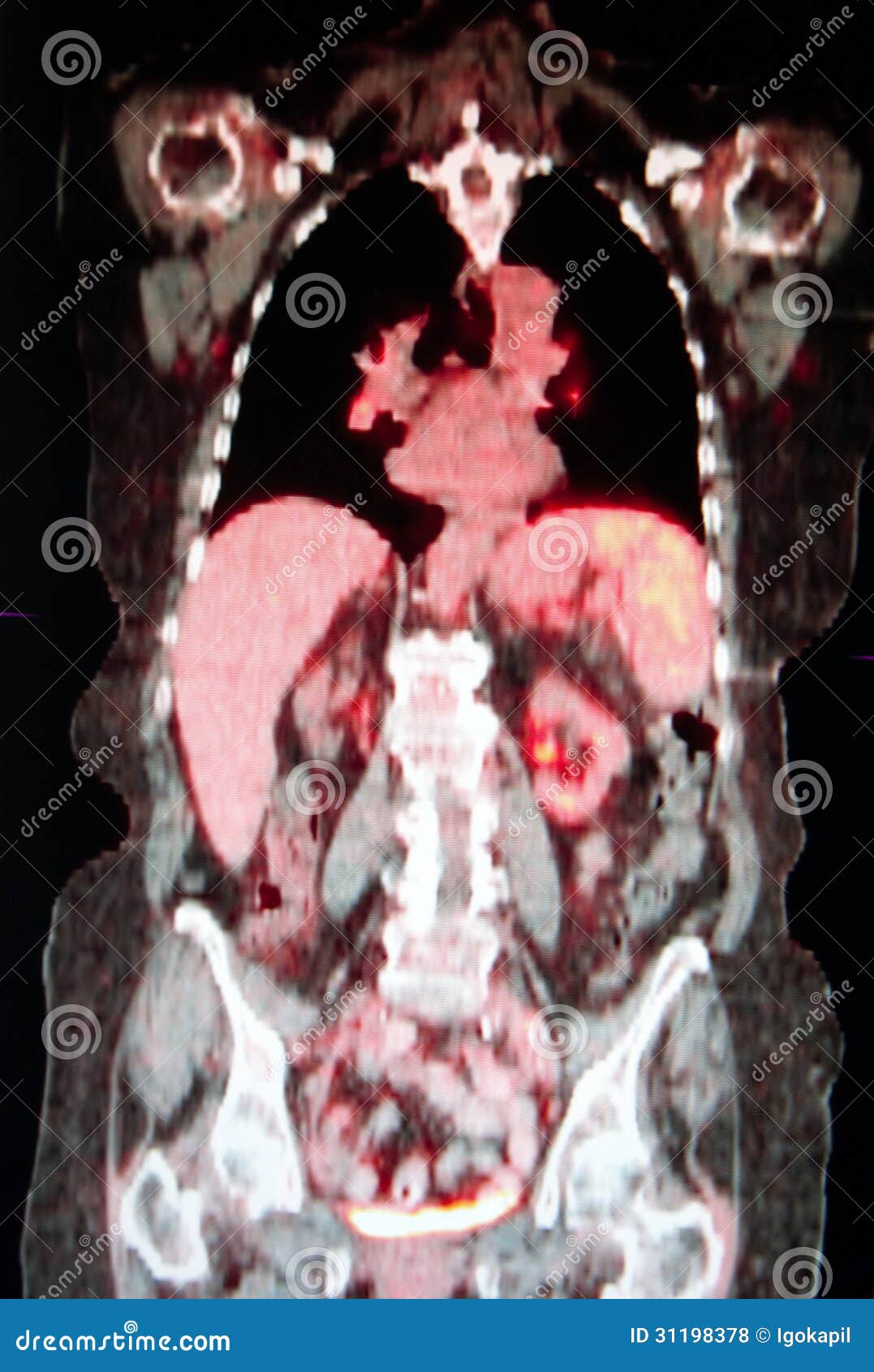 Tomografía Por Emisión De Positrones Foto de archivo - Imagen de ...