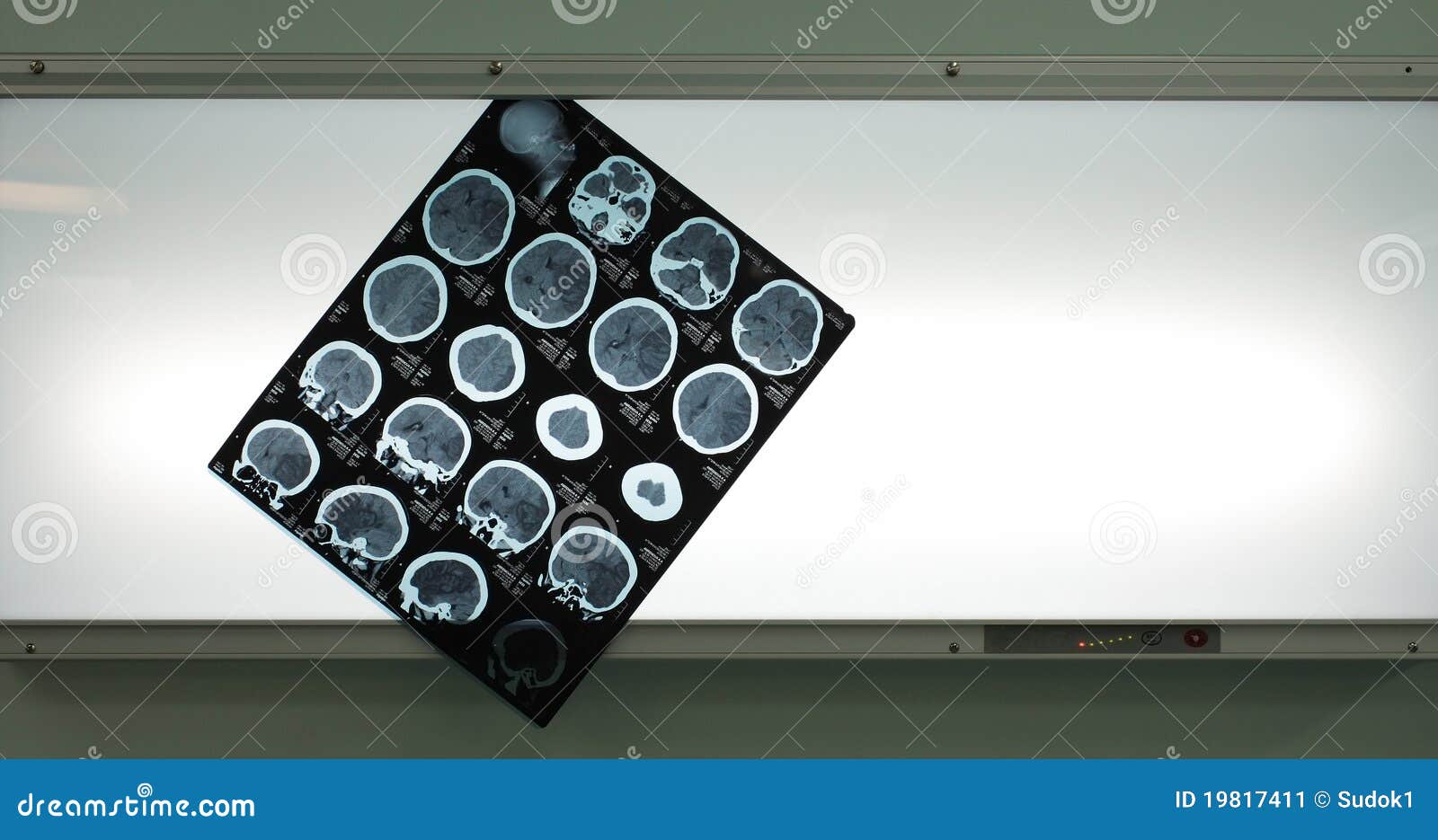 Tomogram at negatoscope stock image. Image of photograph - 19817411