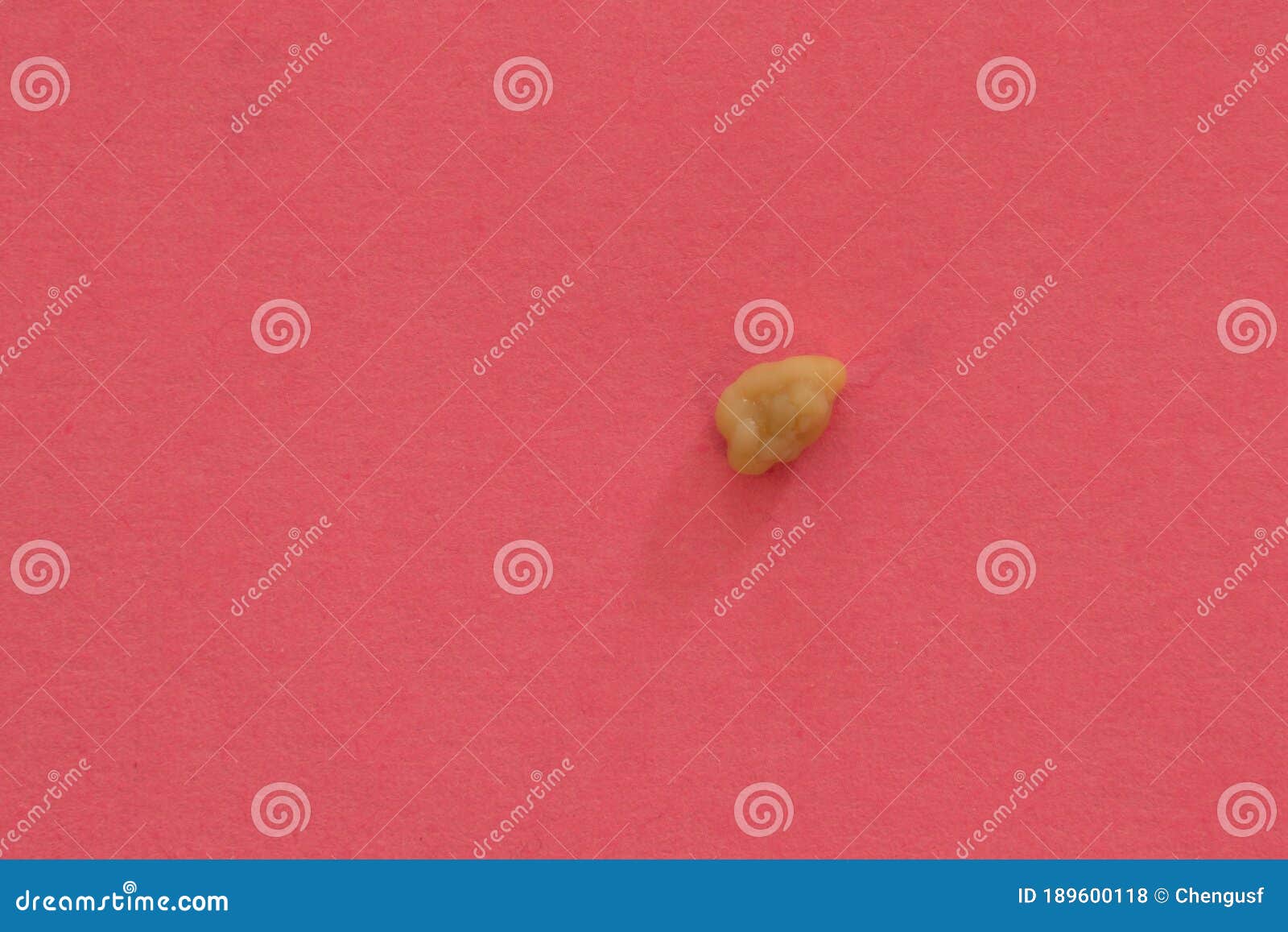 Tonsil stone tonsillolith stock photo. Image of calculi - 189600118