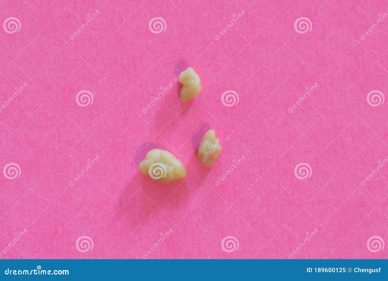 Tonsil stone tonsillolith stock image. Image of halitosis - 189600125