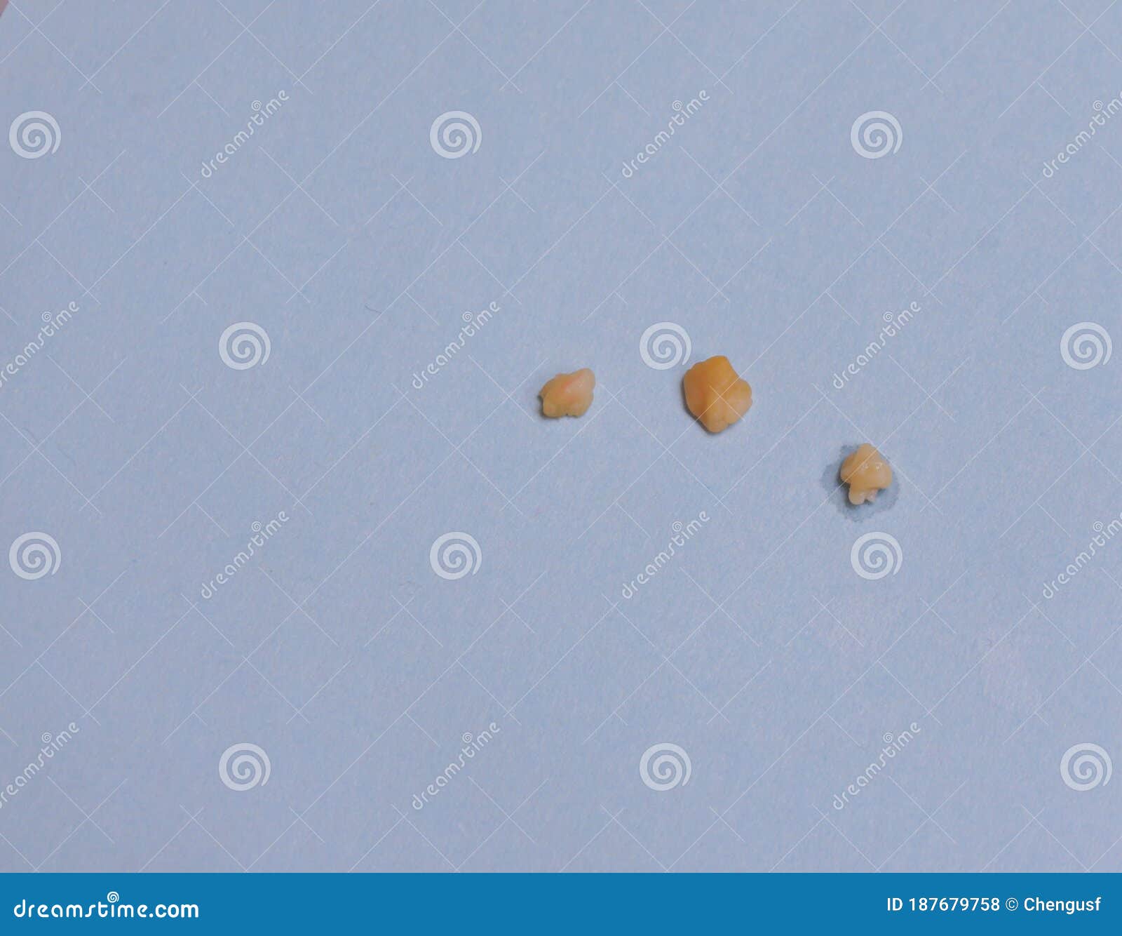 Tonsil stone tonsillolith stock photo. Image of human - 187679758