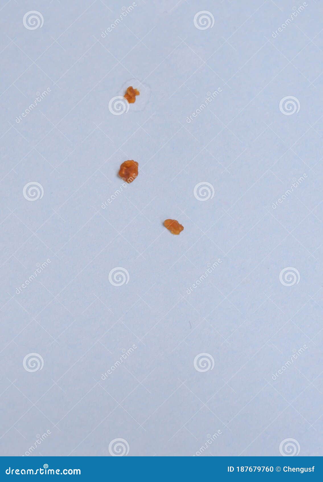Tonsil Stone Tonsillolith Royalty-Free Stock Image | CartoonDealer.com ...
