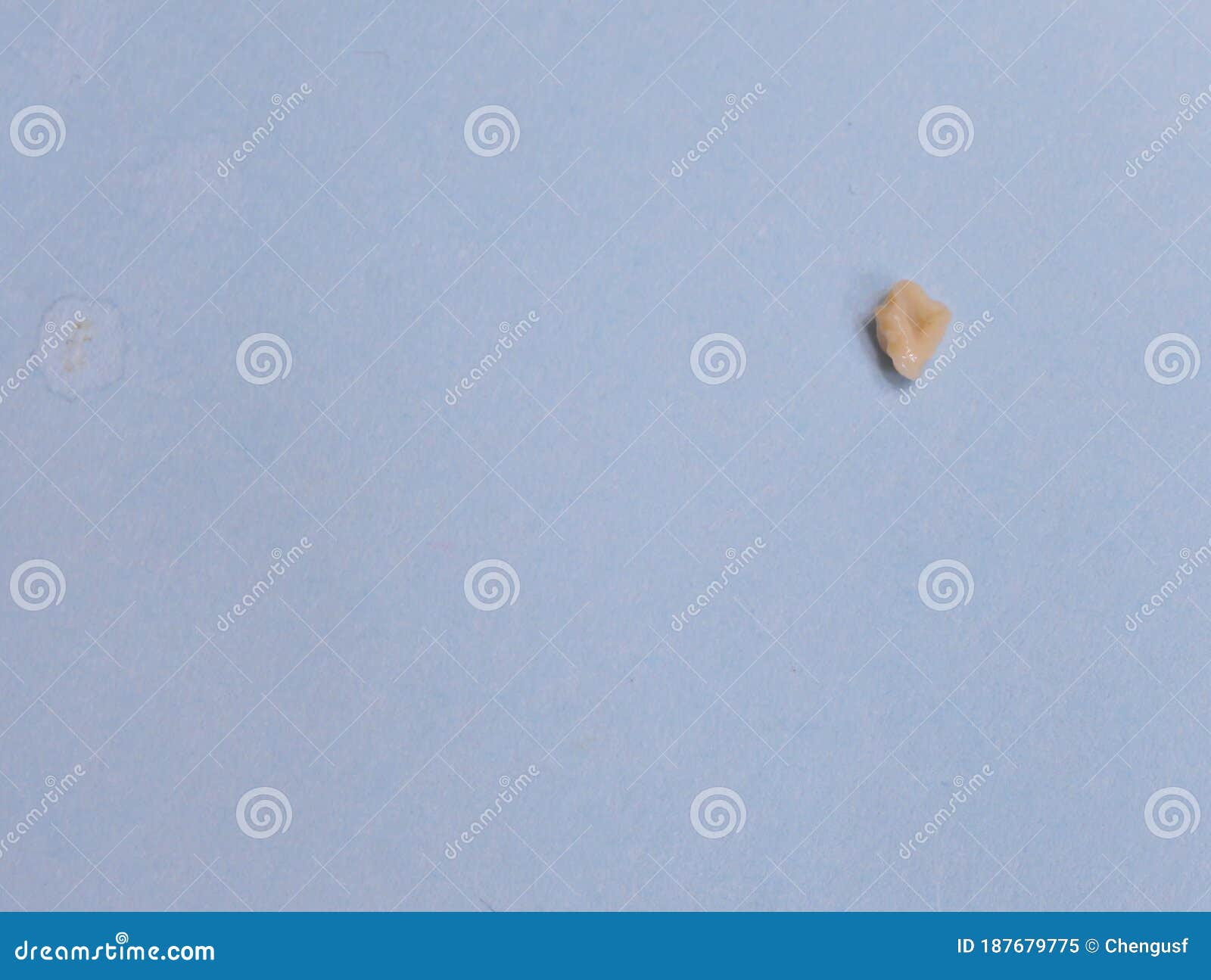 Tonsil stone tonsillolith stock image. Image of medical - 187679775