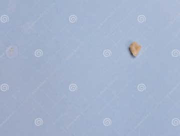 Tonsil stone tonsillolith stock image. Image of medical - 187679775