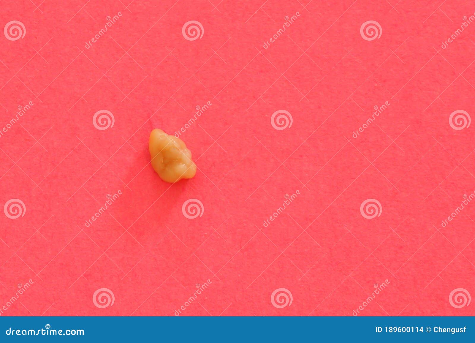 Tonsil stone tonsillolith stock photo. Image of cavity - 189600114