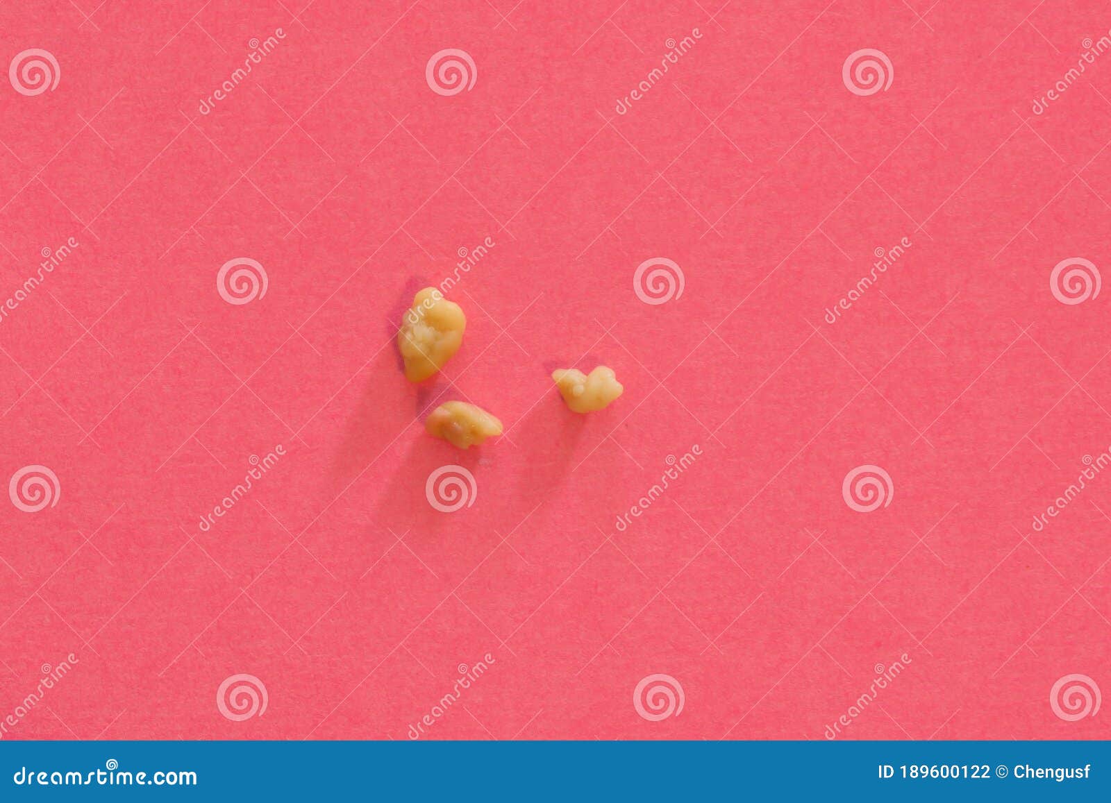 Tonsil stone tonsillolith stock photo. Image of bacterial - 189600122