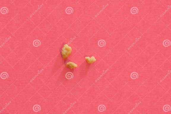 Tonsil stone tonsillolith stock photo. Image of bacterial - 189600122