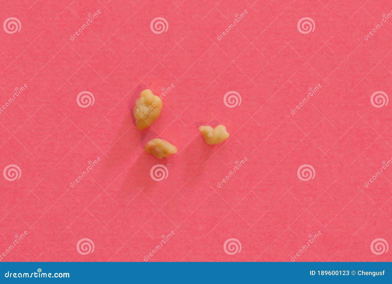 Tonsil stone tonsillolith stock image. Image of deep - 189600123