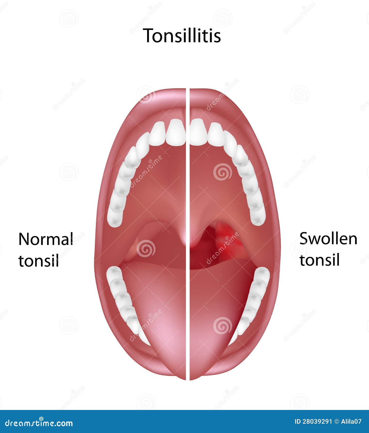 Tonsilitis Imagen de archivo - Imagen: 28039291