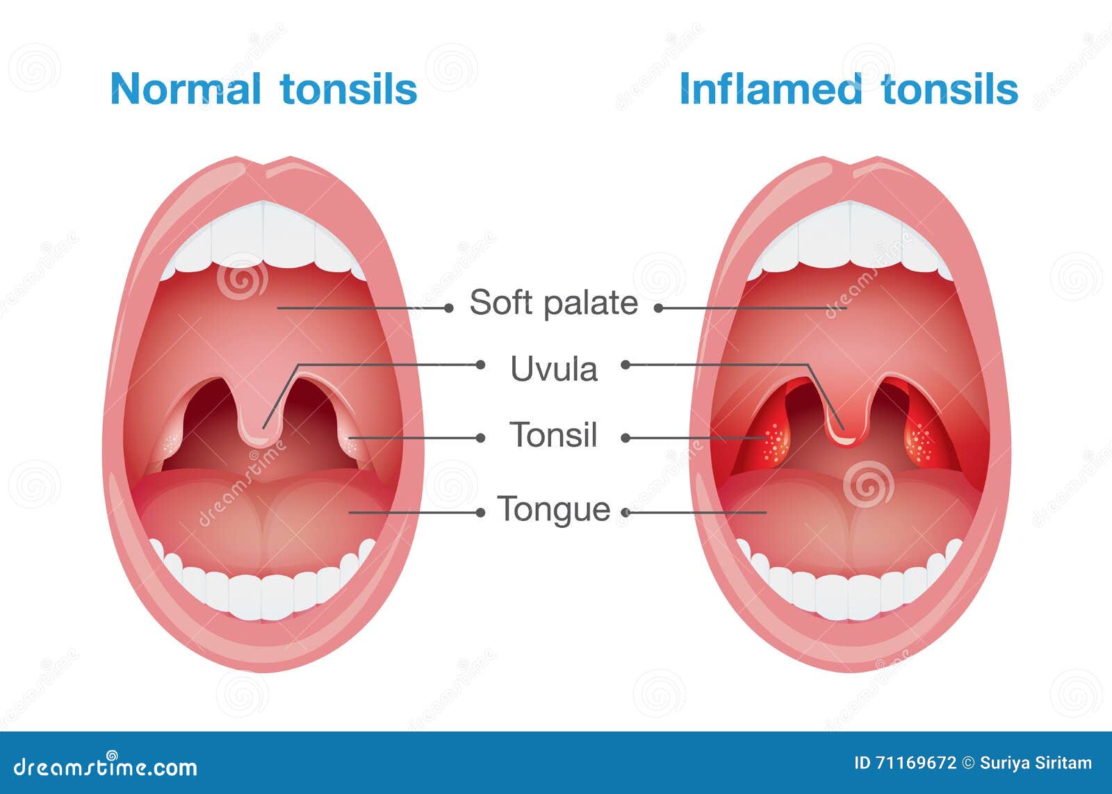 Tonsille Normali E Tonsille Infiammate Illustrazione Vettoriale - Illustrazione di malattia ...