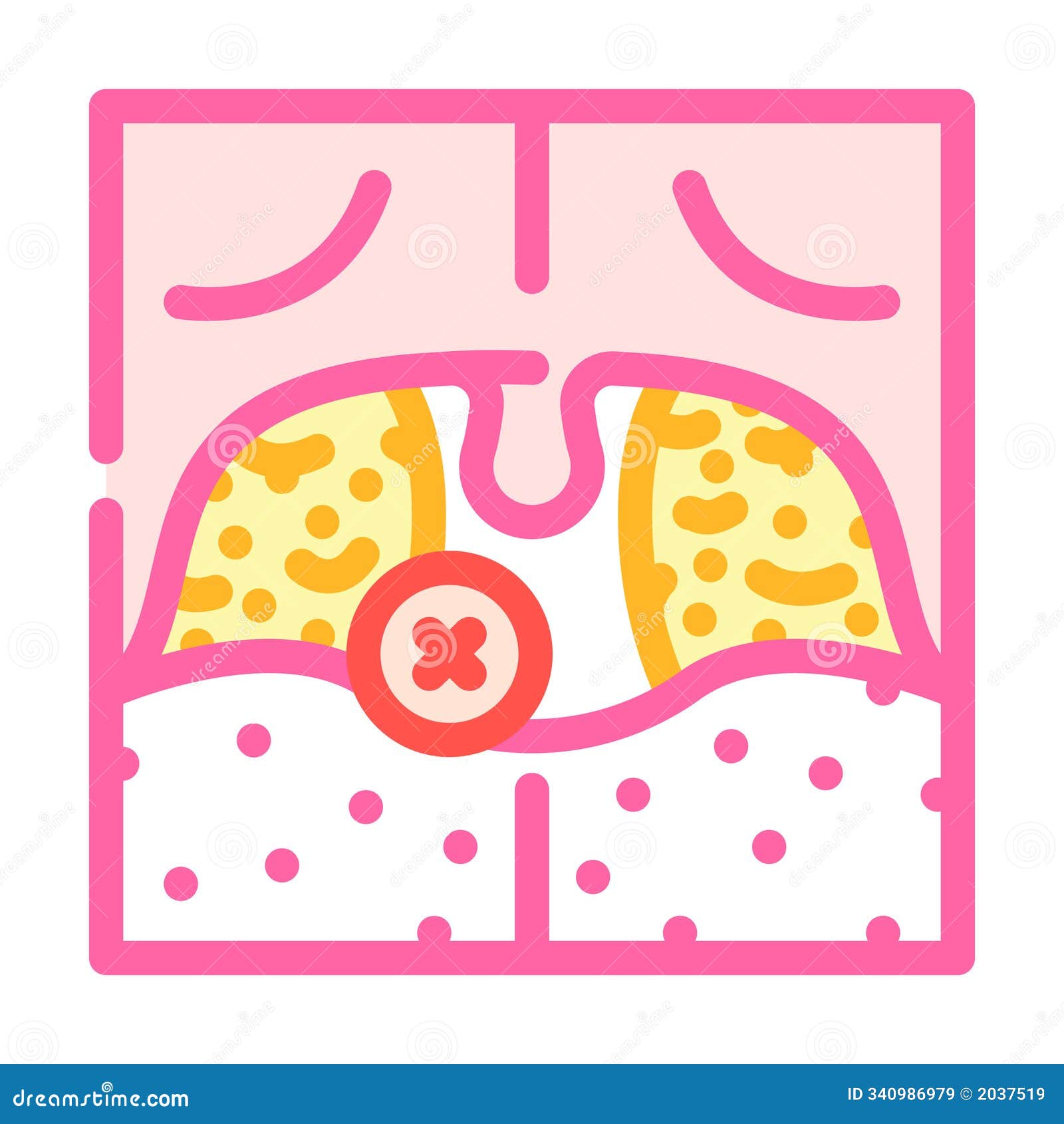 Tonsillectomy Cartoons, Illustrations & Vector Stock Images - 95 ...