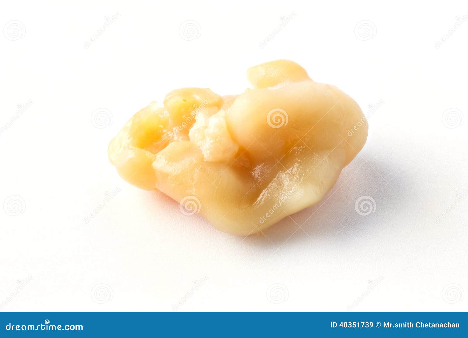 Tonsil Stone Tonsillolith Stock Photos - Free & Royalty-Free Stock ...