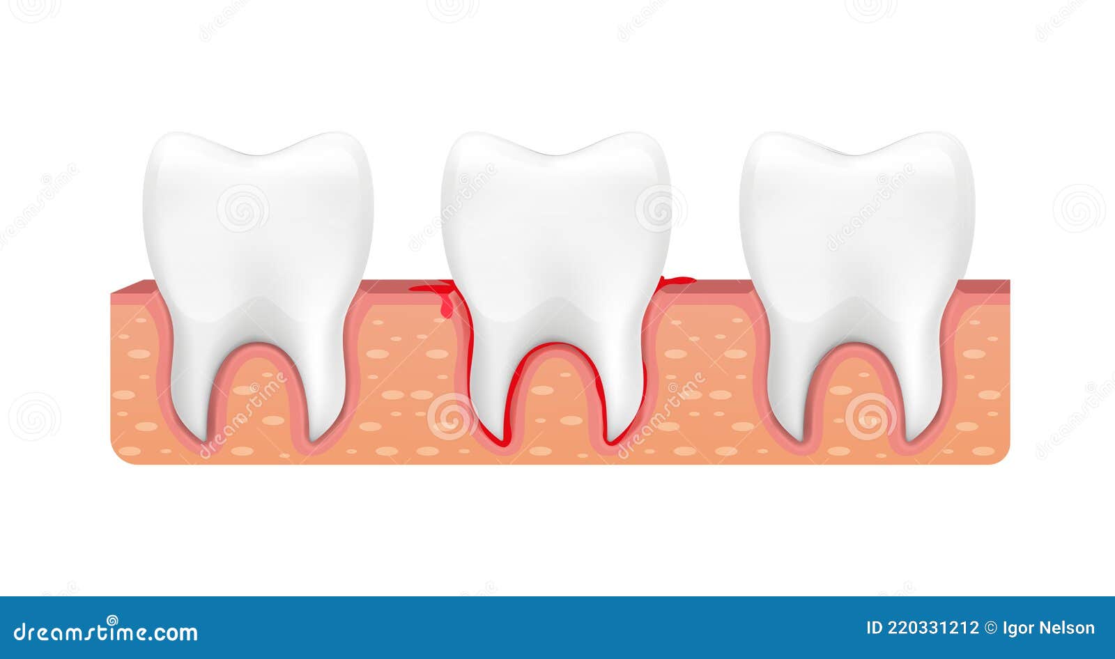 Tooth is Bleeding in the Gum. Blood Teeth. Vector Stock Vector ...