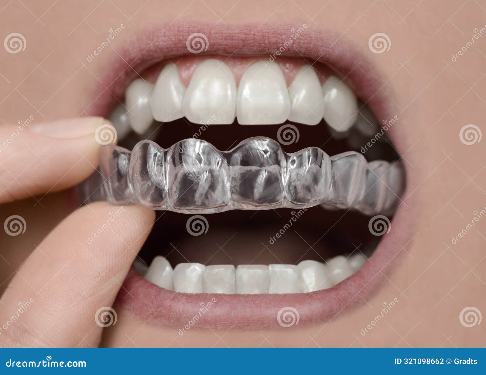 Tooth Braces Aligner Retainer Teeth Bite Rack Stock Photo - Image of ...
