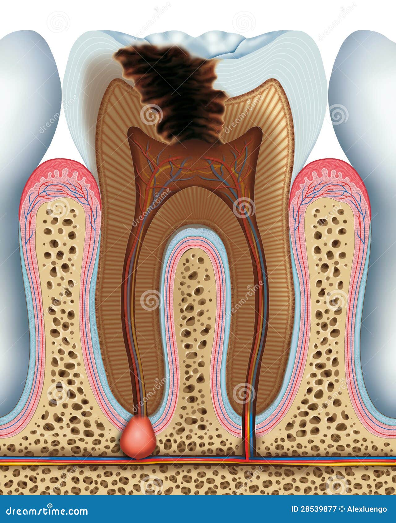 Tooth Caries Stock Image | CartoonDealer.com #28539877