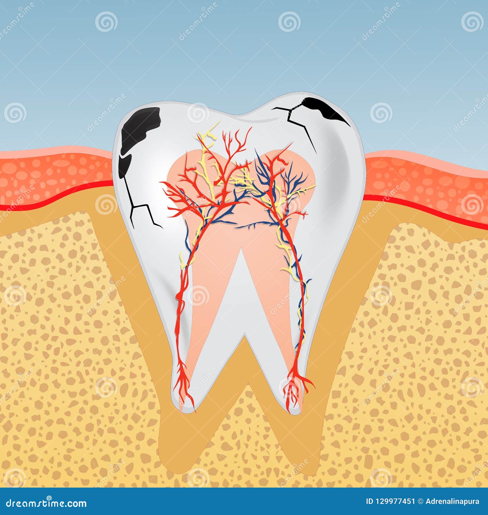 Tooth with caries stock illustration. Illustration of cure - 129977451