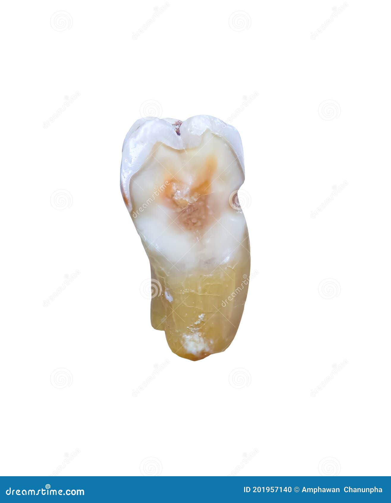 Caries On A Human Tooth On A Dark Background Royalty-Free Stock Image ...