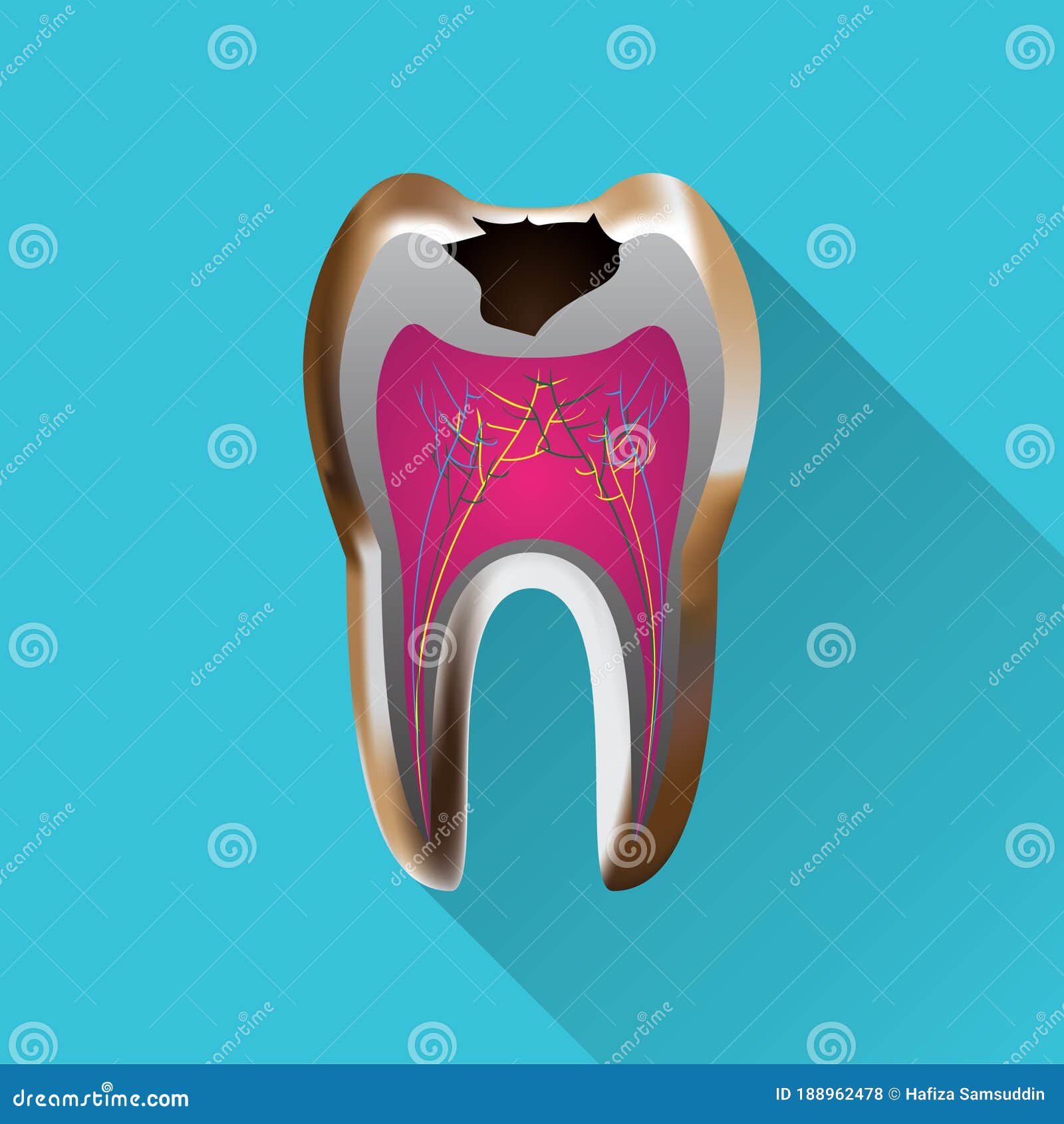 Tooth with Cavity. Vector Illustration Decorative Design Stock Vector ...