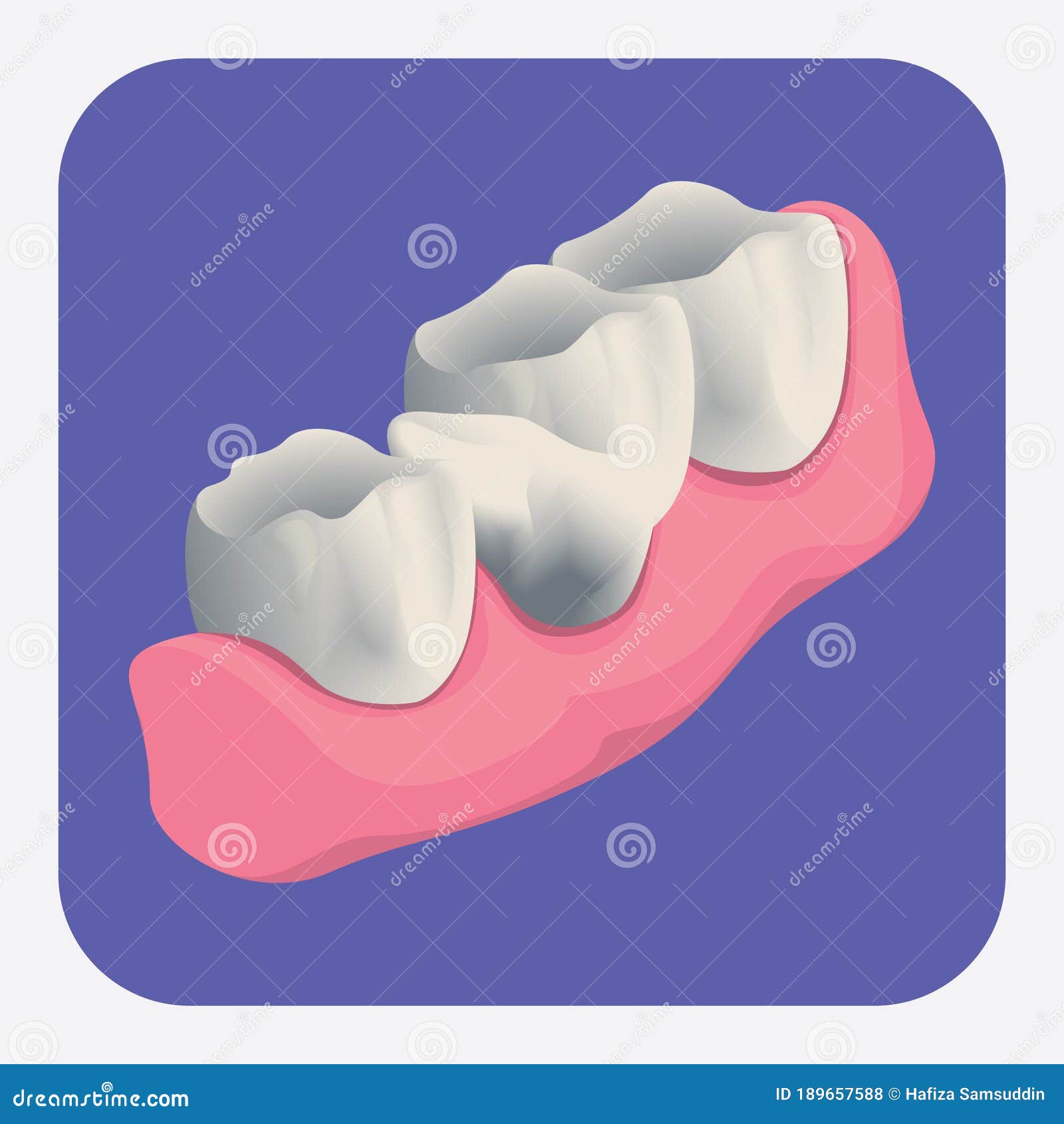 Tooth with Cavity. Vector Illustration Decorative Design Stock Vector ...