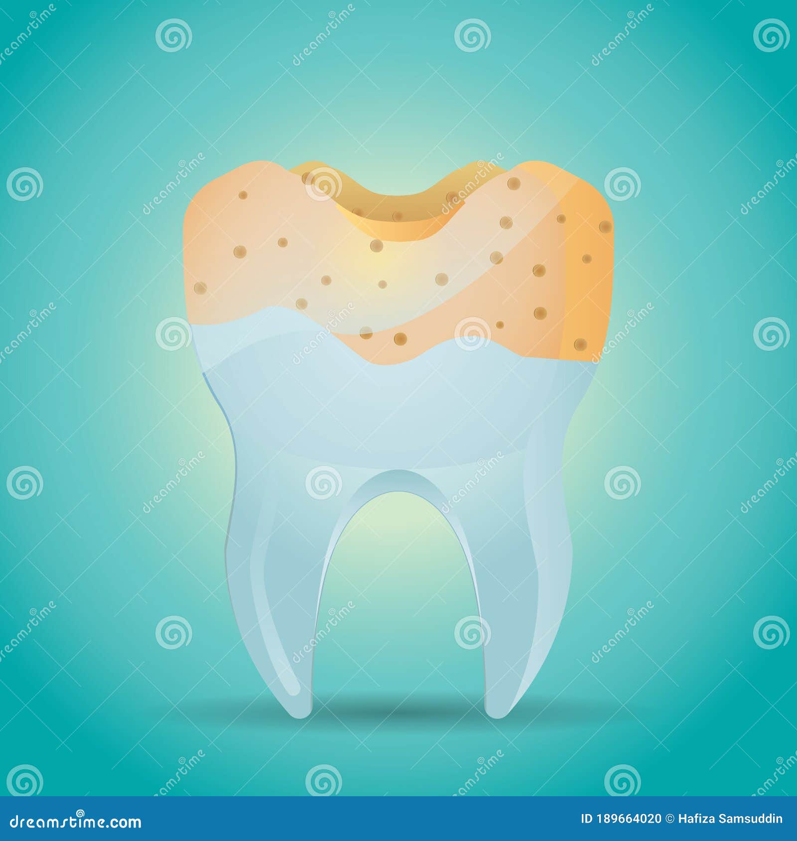 Tooth with Cavity. Vector Illustration Decorative Design Stock Vector ...