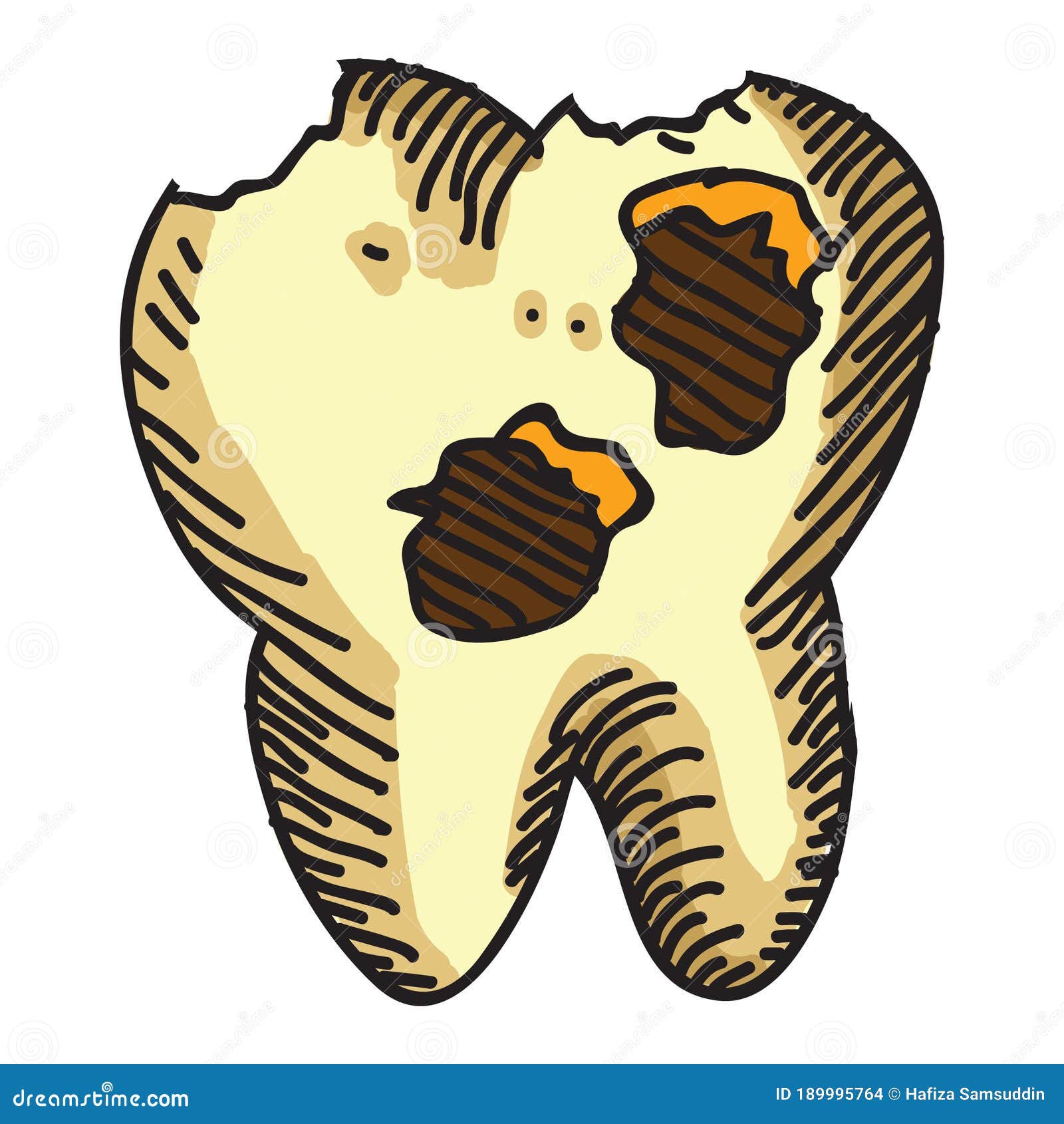 Tooth Cavity. Vector Illustration Decorative Design Stock Vector ...