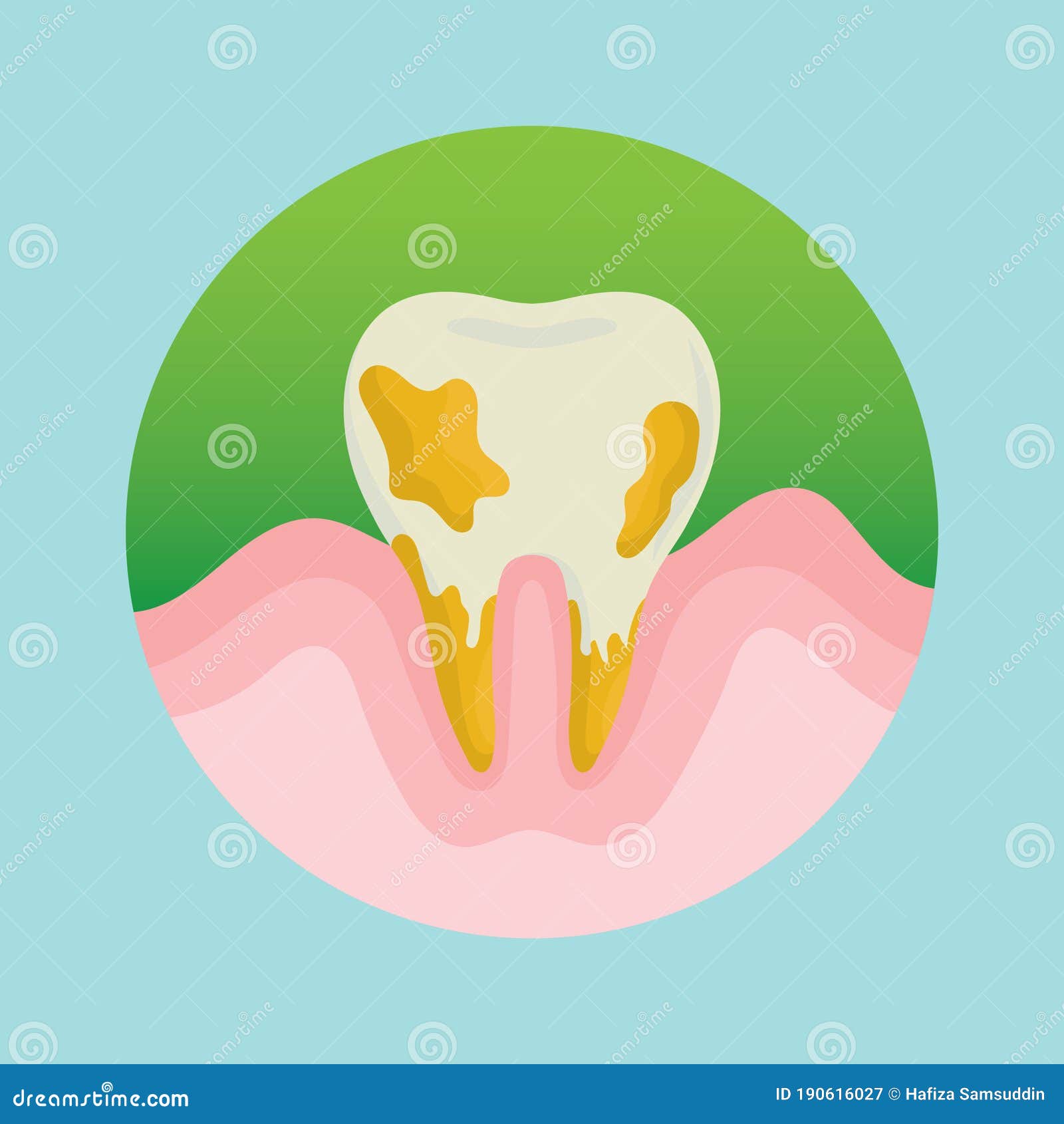 Tooth with Cavity. Vector Illustration Decorative Design Stock Vector ...